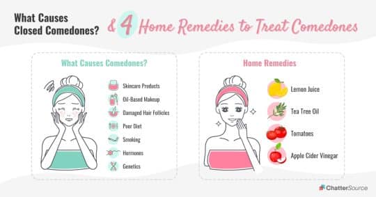 How To Treat Closed Comedones | ChatterSource
